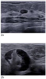 Cas clinique d’adénopathie axillaire | Excellence Imagerie